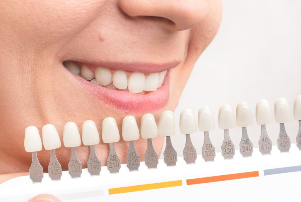 Porcelain Dental Crowns for a Smile Transformation - Xceptional Dental